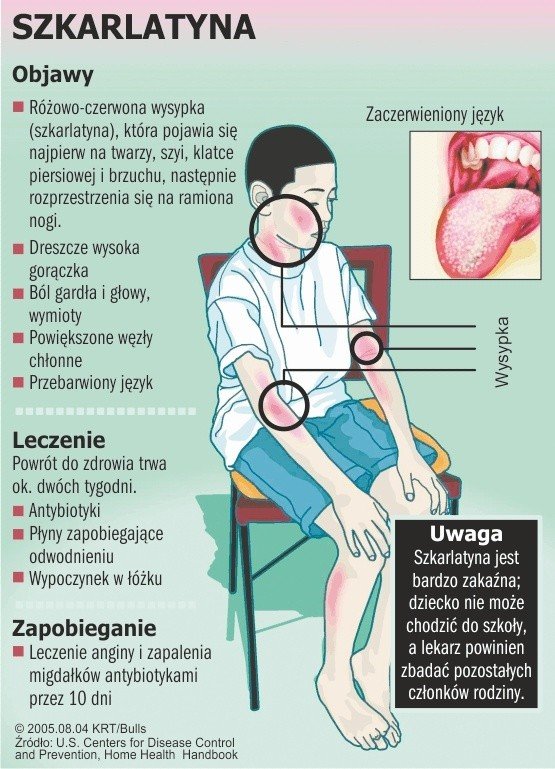 Stilvolle Objawy Szkarlatyna Zdjecia Bilder